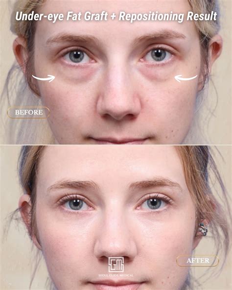 👁 Under Eye Fat Graft Seoul Guide Medical Facebook