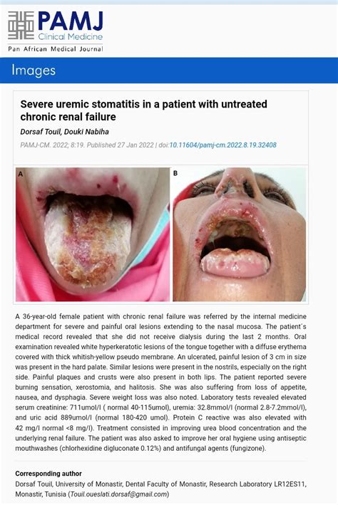 Uremic Stomatitis Online First Uremic Head And Neck Pathology
