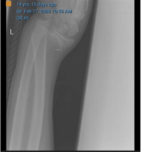 So 14 Years Ago I Broke Both My Arms At The Same Time 4 Breaks Radius