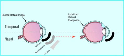 Regional Blur Causes Axial Elongation Regional Retinal Blur Created In