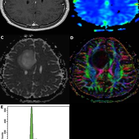 A Year Old Male Patient With A Diffuse Astrocytoma A Download Scientific Diagram