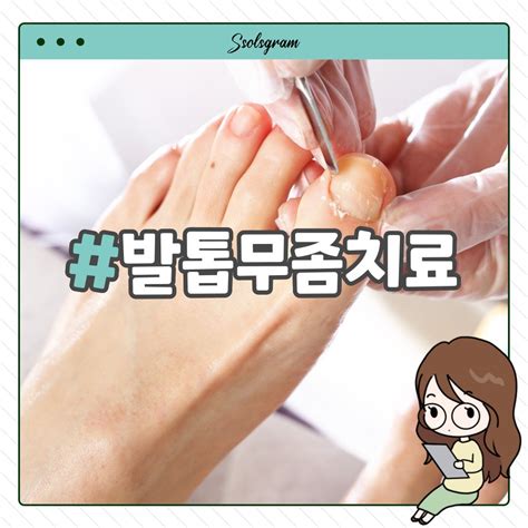 엄지 발톱무좀 치료 및 증상 자세히 알고 관리하자 네이버 포스트