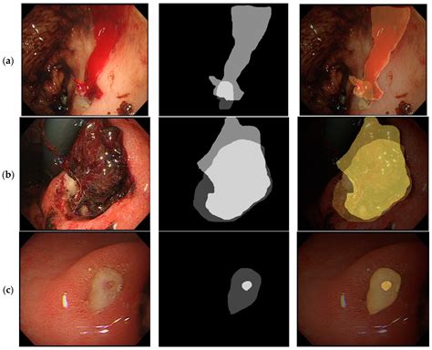 Forrest Classification For Bleeding Peptic Ulcer A New Look At The Old Endoscopic Classification