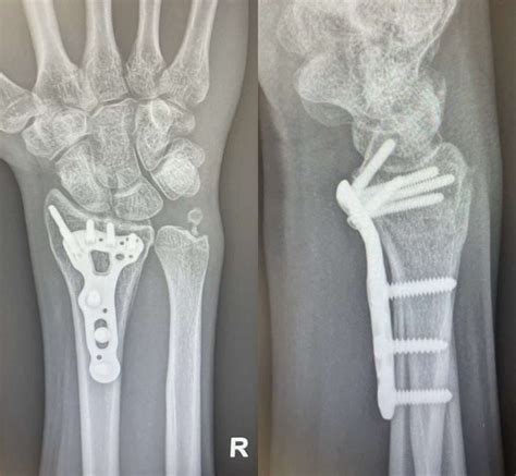 Wrist Fracture Surgery London And Kent