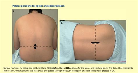 Techniques Of Epidural Block Anaesthesia And Intensive Care Medicine