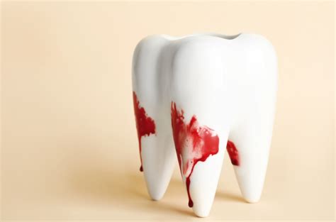 Bleeding After Tooth Extraction Know How To Stop It