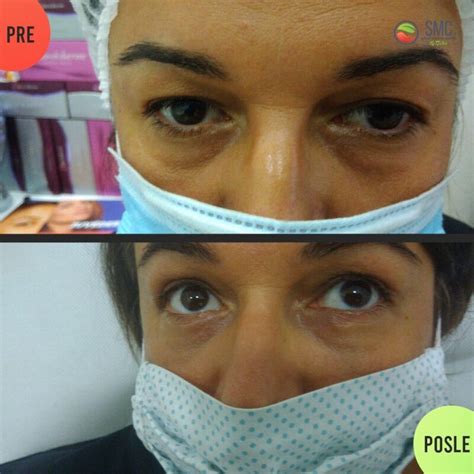 Blefaroplastika Hirurgija Kapaka Solar Medical Center