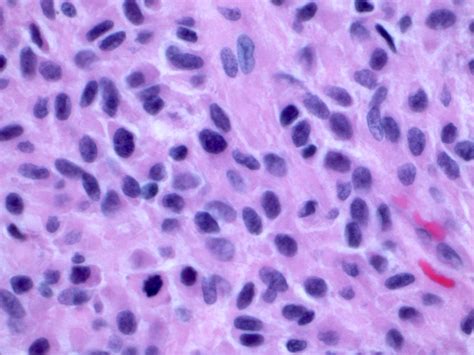 Pathology Outlines Gastrointestinal Stromal Tumor