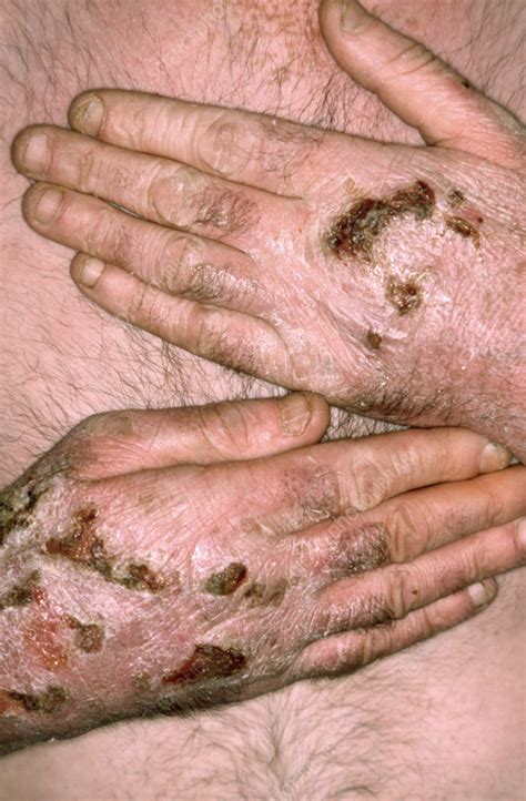 Infectious Ecthyma Stock Image C062 1112 Science Photo Library