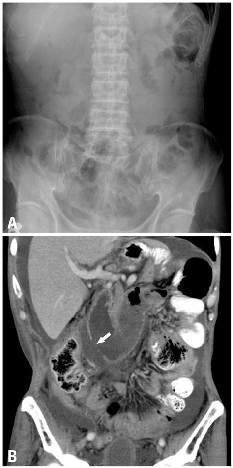 Afferent Loop Obstruction In A 58 Year Old Man After Roux En Y