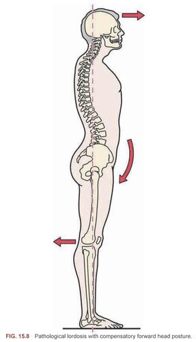 Posture Deviations Quizlet