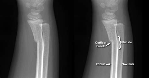 Greenstick Fracture X Ray