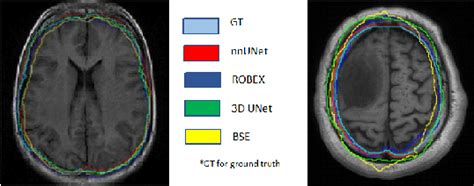 Figure 3 From A Deep Learning Framework For Skull Stripping In Brain