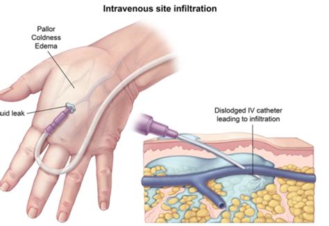 Clin Skills Peripheral Iv Catheter Flashcards Quizlet