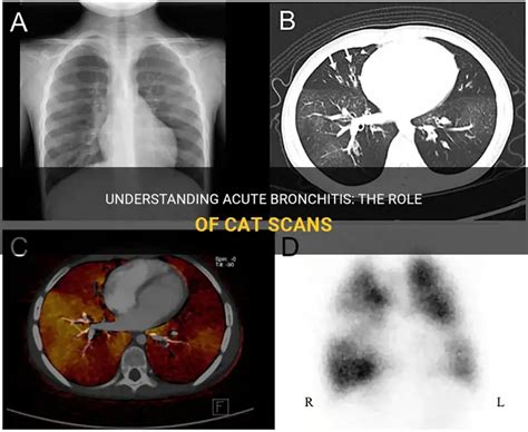 Understanding Acute Bronchitis The Role Of Cat Scans Medshun