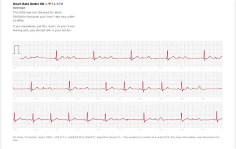 Pvcs And Bigeminy R Readmyecg