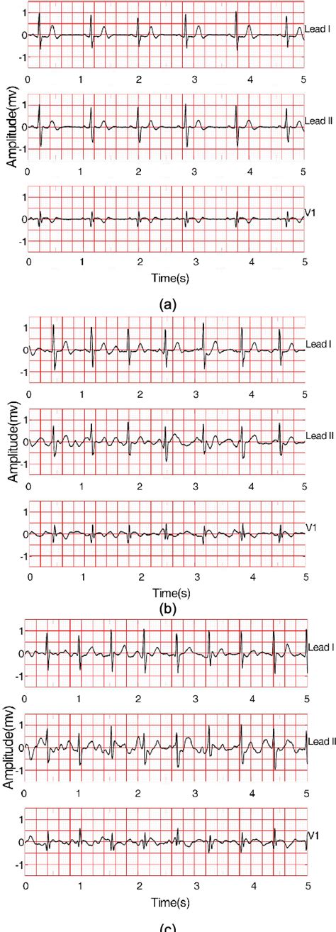 Figure 11 From Low Power Multi Lead Wearable Ecg System With Sensor Data Compression Semantic
