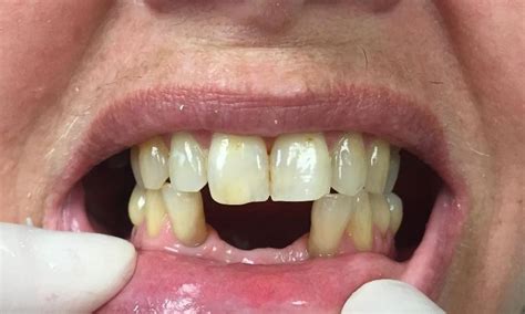 Front Partial Dentures