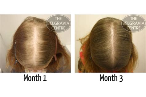 Diffuse Hair Loss Information And Advice