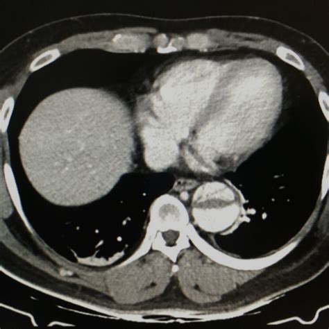 Aortic Dissection Landing Page Rcemlearning India