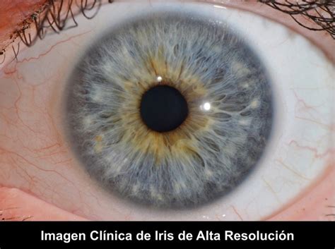 Iriscopios Profesionales Cámaras Para Iridología Iriscopio Digital