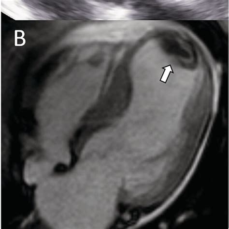 Left Ventricular Thrombus Formation Arrow In A Patient With Acute Download Scientific Diagram