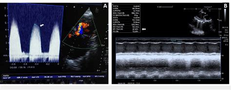 Color Doppler Echocardiography By Continuouswave Tracing In
