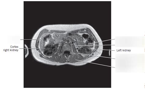 Diagram Of Mr Abdomen 6 81 Quizlet
