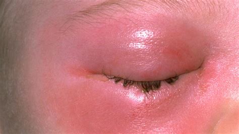 Periorbital Cellulitis Causes Symptoms And Treatment