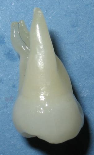 Maxillary Third Molar Flashcards Quizlet