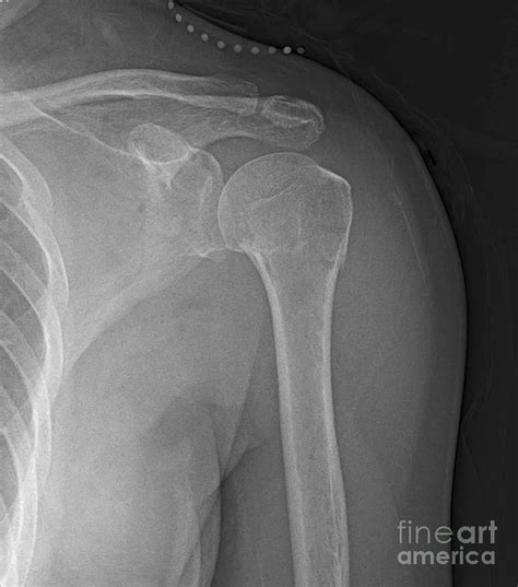 Humerus Fracture 11 By Science Photo Library Humerus Fracture 11 By Science Photo Library
