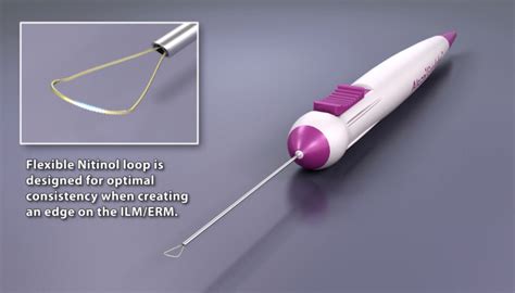 Finesse® Flex Loop Für Ilm Peeling Alcon Deutschland