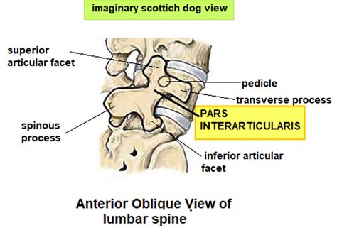Spondylolysis Causes Symptoms Diagnosis Treatment And Prognosis