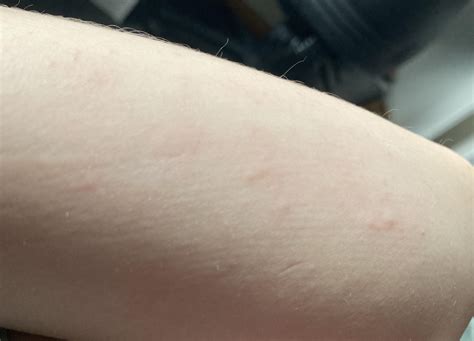 Scabies Or Just Reaction To Permethrin Rscabies