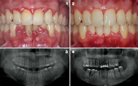 자유게시판 치주질환 잇몸병