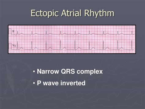 Ppt Basics Of Ekg Interpretation Powerpoint Presentation Free