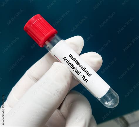 Synovial Fluid Analysis For Undifferentiated Arthritis Ua Or Non