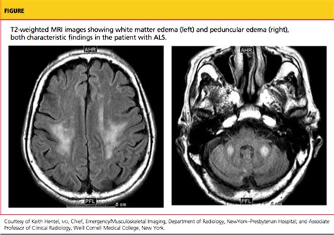 Amyotrophic Lateral Sclerosis Als Disease Signs Symptoms Etsy
