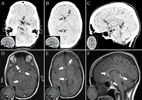 Axial A And B And Sagittal C Cranial Ct Scans Show Multifocal
