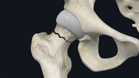Femoral Neck Fractures Orthopedia