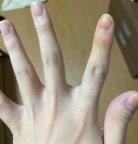 검지손가락이 노란색으로 변색 지식in