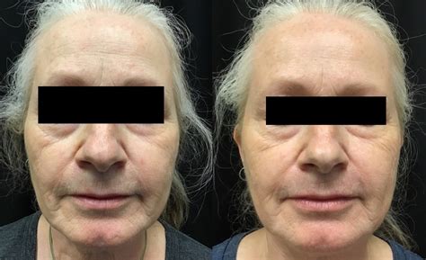 Microneedling Before And After Pictures Of Neck Wrinkles And More
