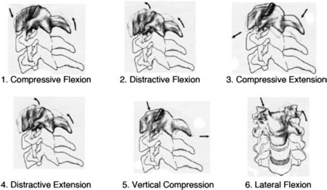 Allen Et Al Divide Cervical Spine Injuries Into The Fo Open I
