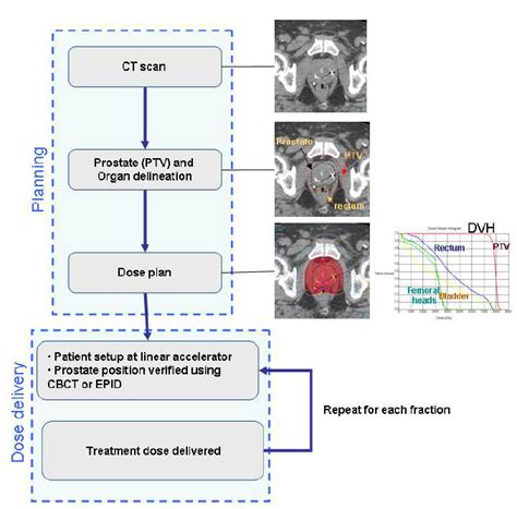 Workflow For Traditional Prostate Cancer Image Guided Radiation Download Scientific Diagram