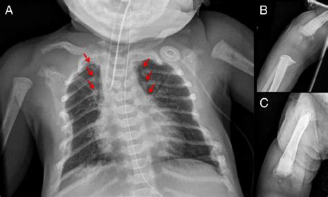 Radiographs Of The Patient Demonstrating Diffuse Demineralization A Download Scientific