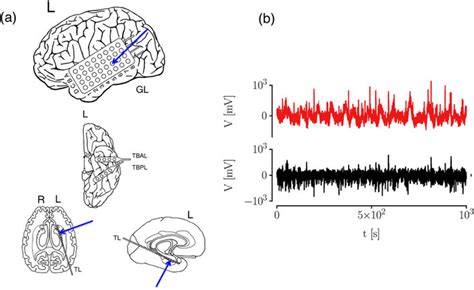 Exemplary Recording Scheme And Intracranial Electroencephalographic Download High Quality