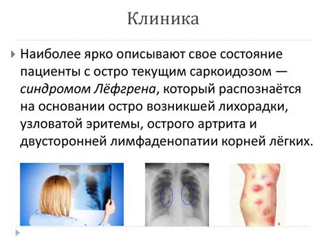 Саркоидоз Анамнез Клиника презентация онлайн