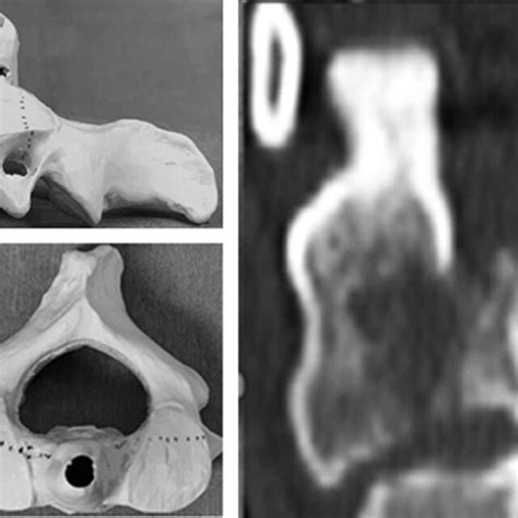 Avulsion Type C2 Vertebral Body Fracture Depicted On An Anatomical