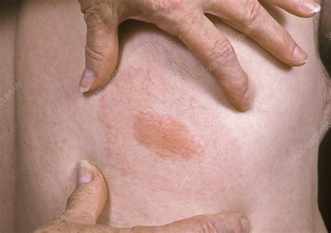 Lyme Disease Rash Stock Image C Science Photo Library