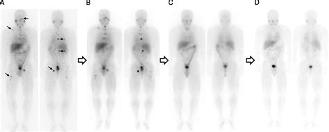Proposed Mibg Scanbased Tumor Response Criteria Of High Spe Clinical Nuclear Medicine